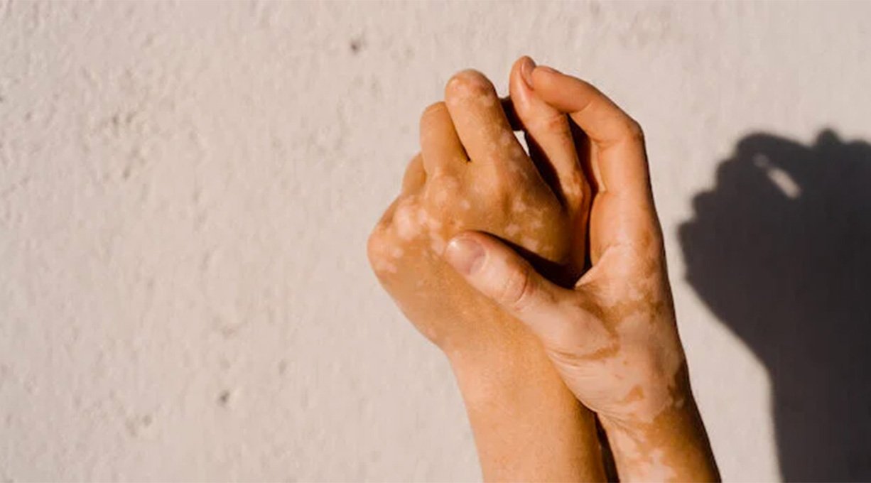 Comment dépigmenter les taches sur la peau ? | VICHY