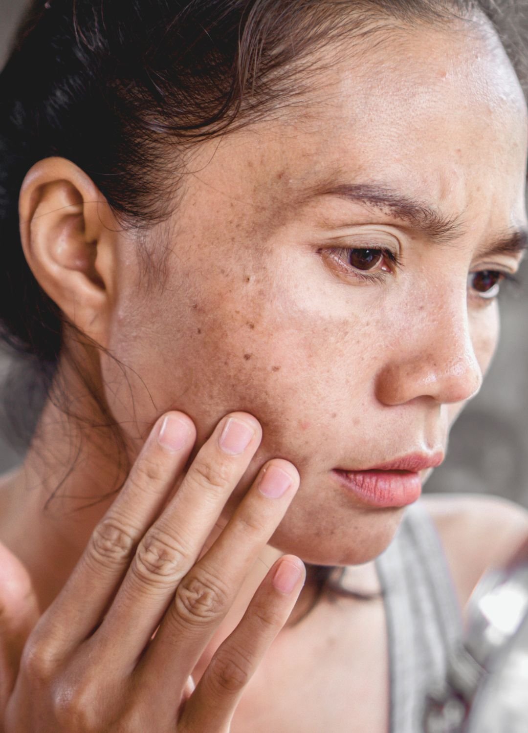 Hyperpigmentation : causes, prévention et soins | VICHY