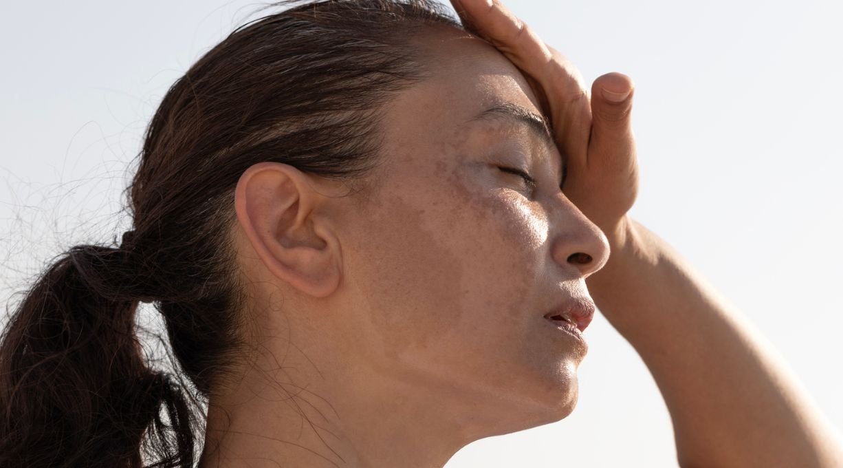 Hyperpigmentation : causes, prévention et soins | VICHY